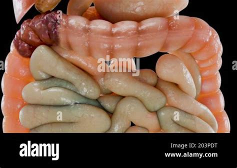 Colorectal Cancer Malignant Tumor In Intestine Endoscope Inside Colonoscopy Gut Intestine
