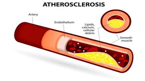 La Hipertrigliceridemia Se Erige En Actor Principal De La Aterogénesis