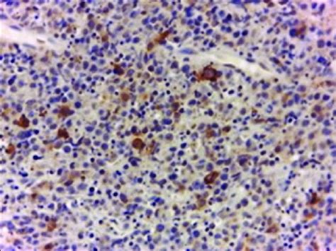 Positive Cd30 Expression Using A Cutoff Value Of 10 Non Germinal