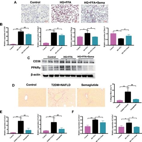 Semaglutide Alleviates Hepatic Lipid Accumulation By Decreasing Fatty
