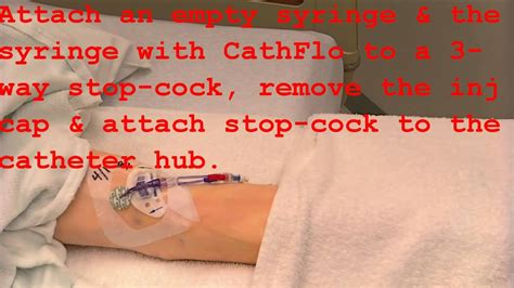 Declotting With Cathflo Youtube