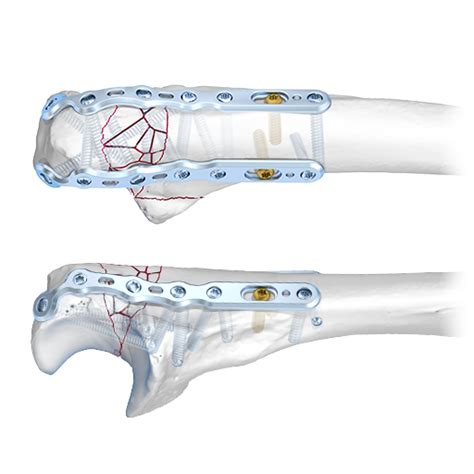 Medartis Olecranon System 2 8