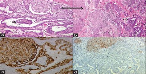 Extensive Squamous Metaplasia In Papillary Carcinoma Of The