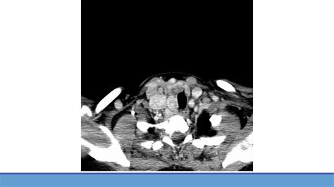 Medullary Thyroid Cancer Pptx