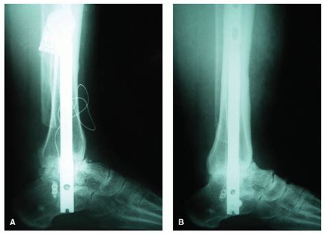 Talar Avascular Necrosis Musculoskeletal Key