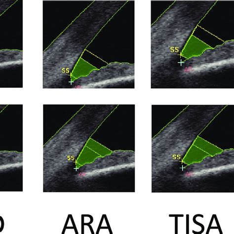 Iridotrabecular Angle Parameters As Measured With The Casia As Oct