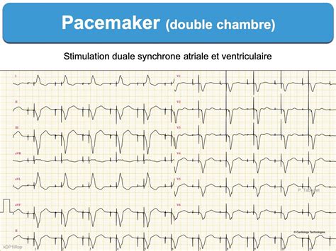 Spike E Cardiogram