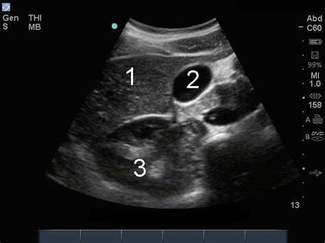 Gallbladder Transverse View Image Sonosite Institute For Point Of