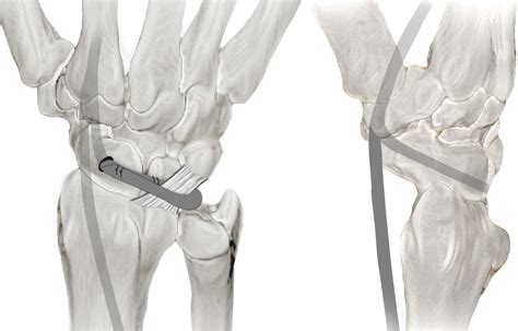 Preoperative And Postoperative Imaging Of Scapholunat
