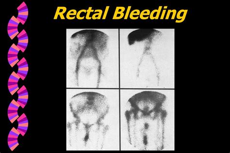 Ppt Gi Bleeding Scan Powerpoint Presentation Free Download Id4496296