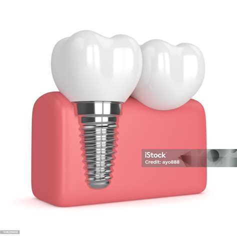 임 플 란 트 치과 외팔보 다리와의 3d 렌더링 임플란트에 대한 스톡 사진 및 기타 이미지 임플란트 치아 건강 이빨 Istock