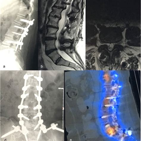 Lumbarisation L56 A Pre Existing L1 L4 Spinal Instrumentation Download Scientific Diagram Lumbarisation L56 A Pre Existing L1 L4 Spinal Instrumentation Download Scientific Diagram