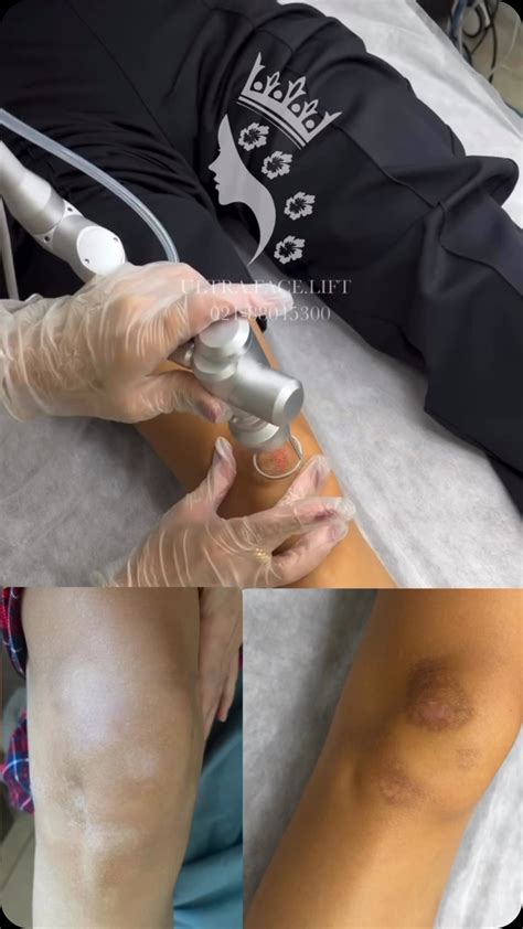 Prase ‎رفع جای جوش و آکنه ، درمان مشکلات هورمونی ۰۲۱ ۲۲۸۷۵۱۹۳