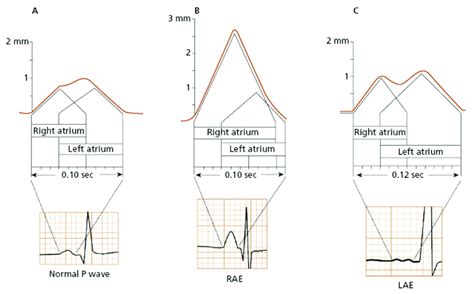 The Visual Representation Of The Atrial Depolarization In A Normal Download Scientific Diagram
