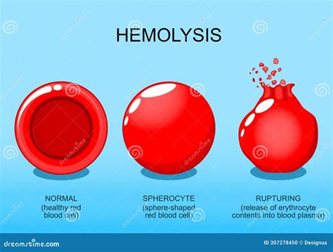 Hemolysis Normal Red Blood Cell Spherocyte And Rupturing Of