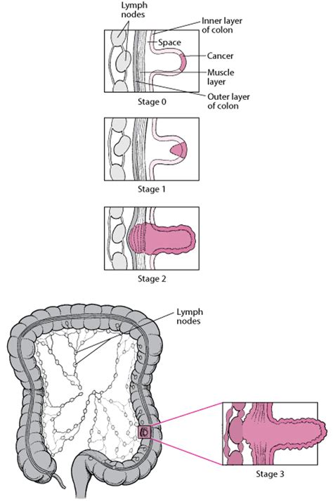 Imagestaging Colon Cancer Msd Manual Consumer Version