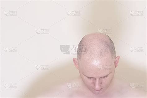 脱发男性型脱发男性头顶秃顶