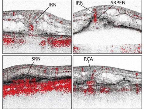 Examples Of Vascular Features Derived From De Jong Et Al 2018 Left