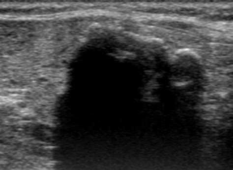 Benign Nodule With Isolated Macrocalcification In A 56 Year Old Woman Download Scientific