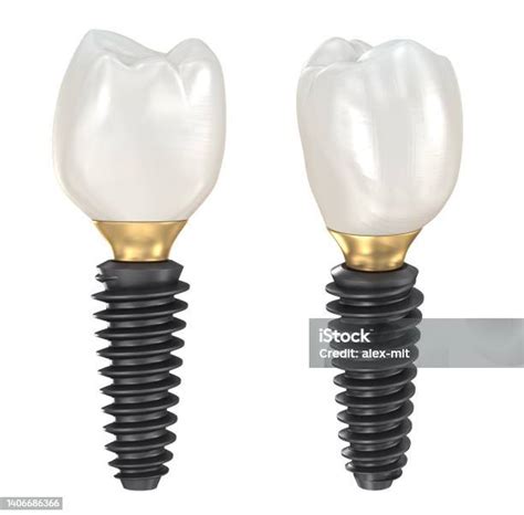 치과 임플란트 및 세라믹 크라운 의학적으로 정확한 치아 3d 그림 0명에 대한 스톡 사진 및 기타 이미지 0명 건강관리와 의술 도예 Istock