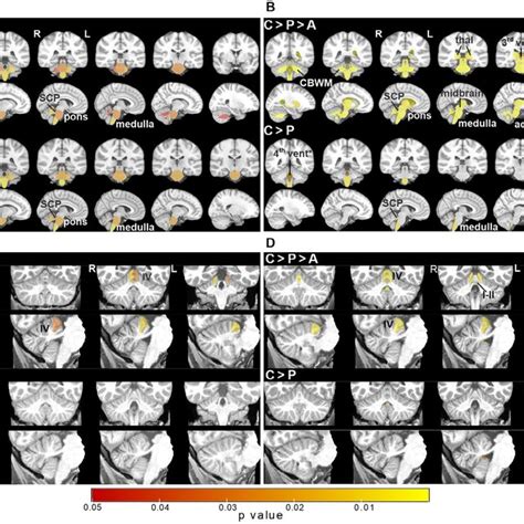 Whole Brain And Cerebellar Volumetry Statistical Maps Of Whole Brain Download Scientific