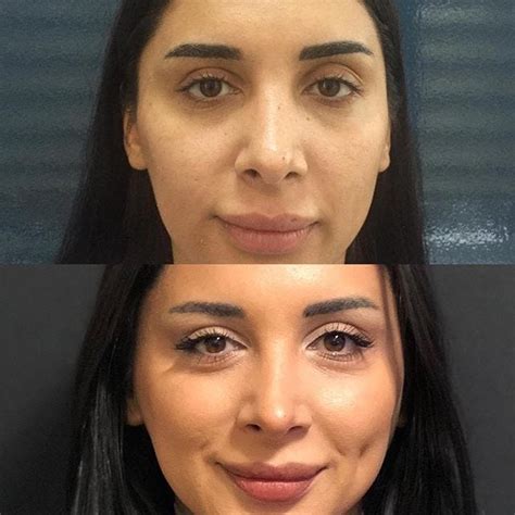 Badem Göz Estetiği Nedir Lokal Ya Da Genel Anestezi Altında By
