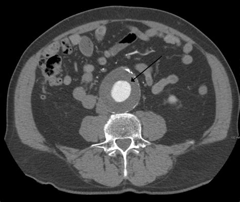 Abdominal Aortic Aneurysm Cardiovascular Medbullets Step 1