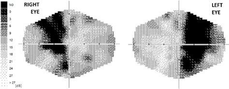 Visual Field Of The Right And Left Eye Download Scientific Diagram