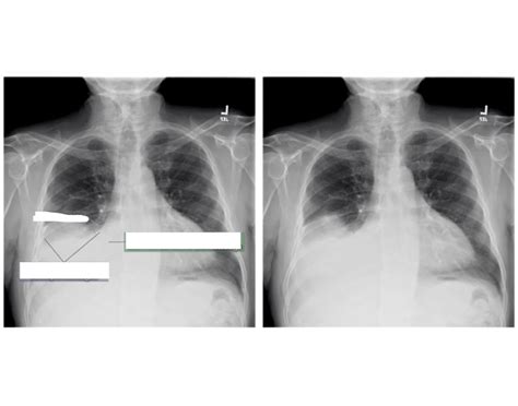 Cxr Pleural Effusion Quiz