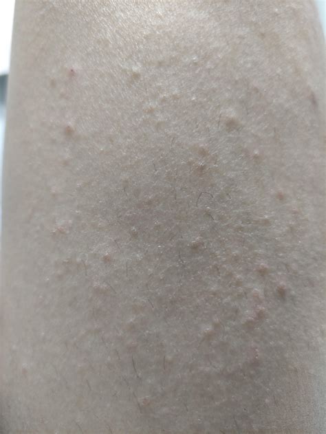 Is This An Hiv Rash Appeared 1 Month After Sex With Stranger It Was