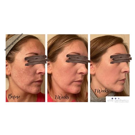 Botox Price Overland Park Kansas