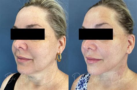 Will Weight Loss Or Weight Gain Affect My Facelift Claytor Noone Plastic Surgery