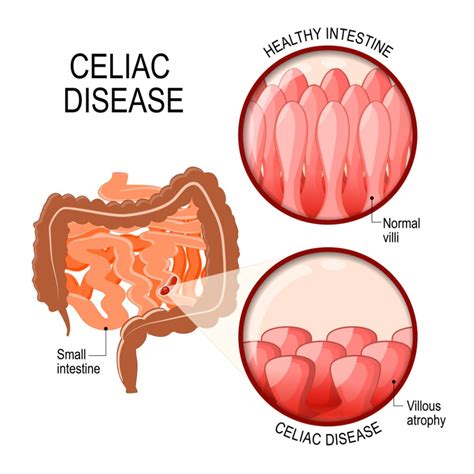 Foods To Avoid If You Suffer With Coeliac Disease