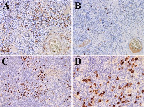 Figure2light Microscopic Examination Of A Lymph Node Biopsy Specimen