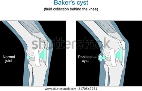Bakers Cyst Fluid Collection Behind Knee Vetor Stock Livre De
