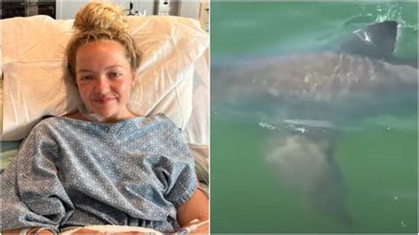 Joven de 17 años que fue atacada por un tiburón en Florida perderá la