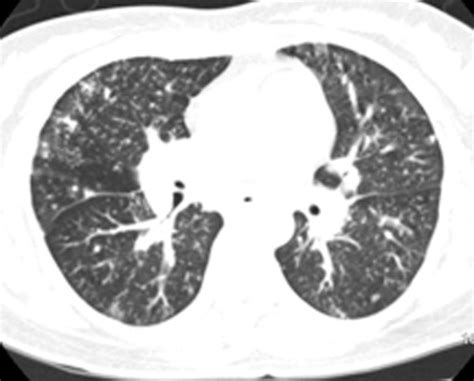 Chest Ct Displaying Diffuse Nodular Parenchymal Infiltrates With