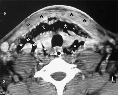 A Year Old Woman With Aids Presents With A Palpable Painful Neck Download Scientific