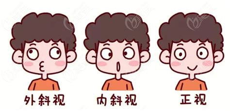 斜视不动手术眼睛会越来越斜吗 重度斜视不手术会越来越斜的 美佳社区