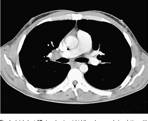 Figure 1 From Case Report Intrapulmonary Lymph Node Metastasis And Renal Cell Carcinoma