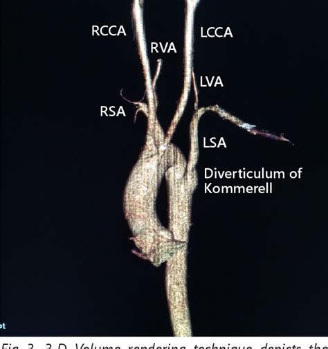 Figure 1 From Right Sided Aortic Arch With Aberrant Left Subclavian
