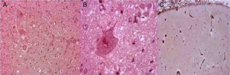A And B Pathological Specimen Showing Dysmorphic Neurons C Download Scientific Diagram