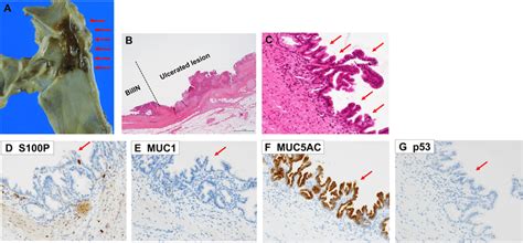 The Macroscopic And Pathological Findings Of The Resected Tumor Arrows