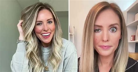 Influencer Shows How Her Eyelid Drooped After Reaction To Botox