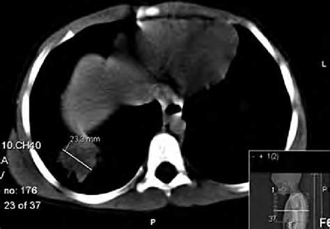 Pulmonary Computed Tomography Scan Showing A 23mm Node On The Right Download Scientific