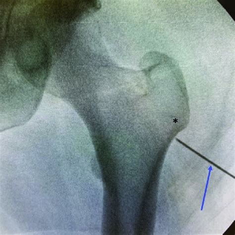 This Fluoroscopic Anteroposterior Image Of A Left Hip Shows The Download Scientific Diagram