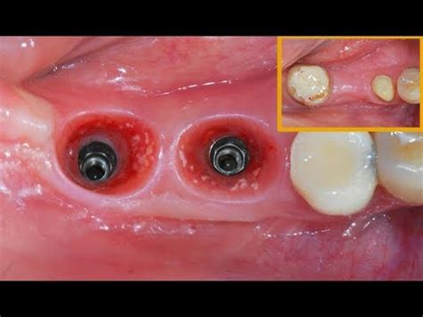 Immediate Implantation With Guided Bone Regeneration Dr Teddy Youtube