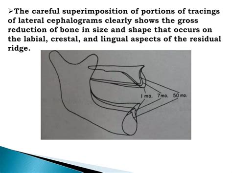 Residual Ridge Resorption Pptx Bone And Joint Conditions Diseases And Conditions