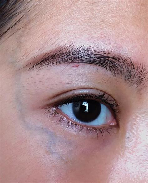 Swollen Eye Veins At David Sells Blog