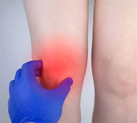 Septic Arthritis Jangkitan Sendi Lutut Yang Mematikan